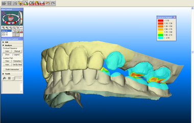 Digital impression technology Tallahassee FL | Periodontal Dentist