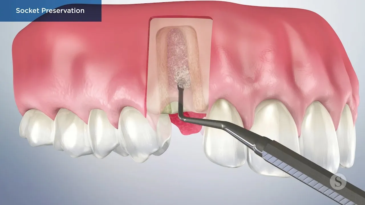 Dental Bone Grafting Tallahassee FL | Tooth Grafting Procedure